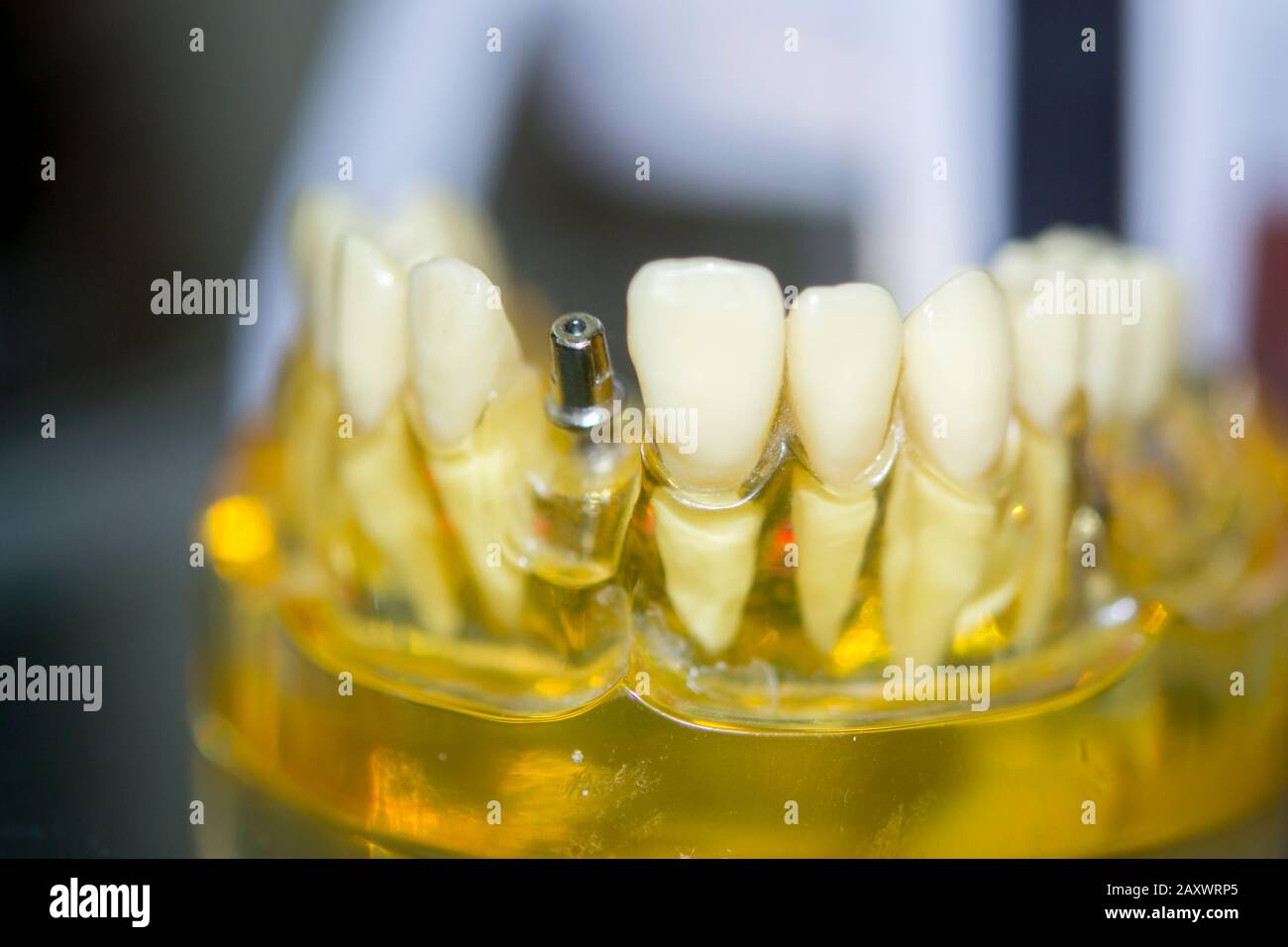 Transparent Model of Human Teeth with implants close-up Stock Photo - Alamy