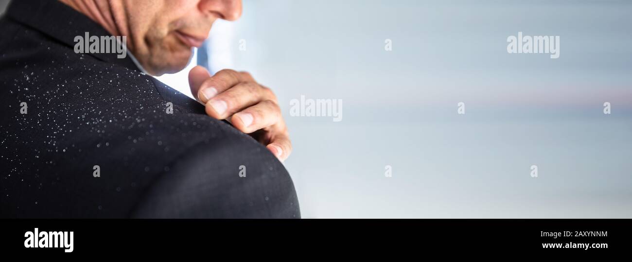 Shoulder dandruff hi-res stock photography and images - Alamy