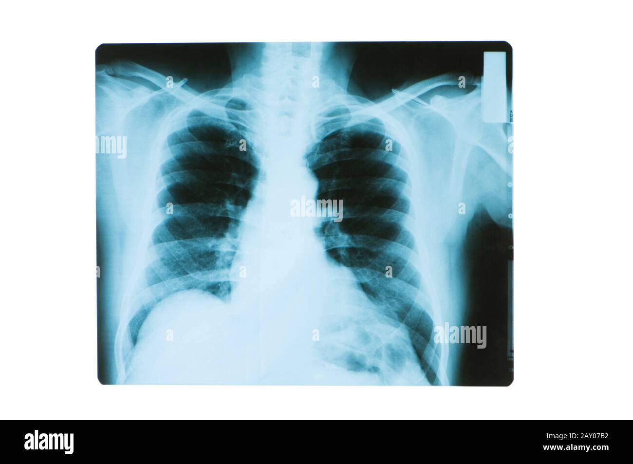 X-ray image of chest bones of adult Stock Photo - Alamy
