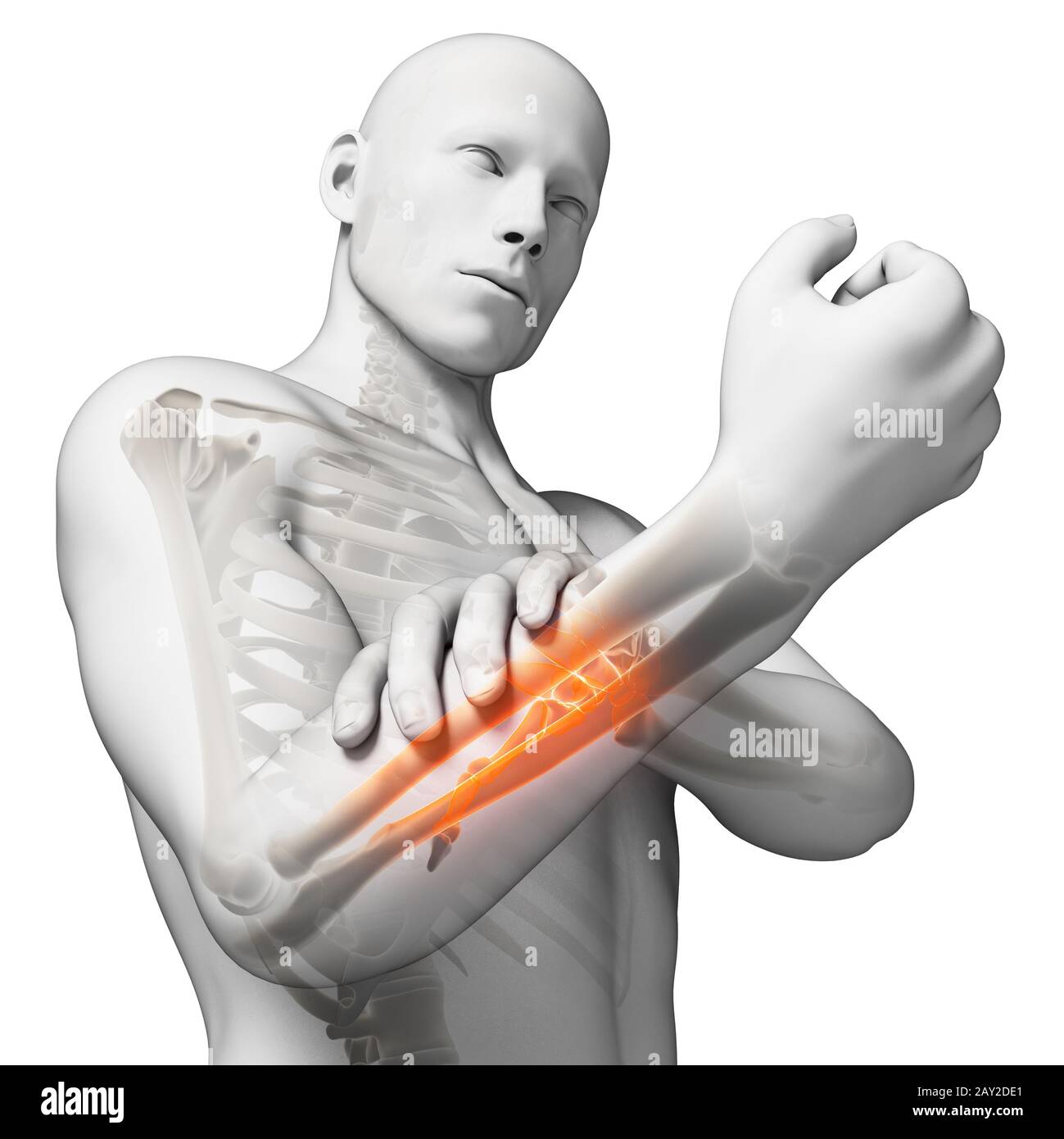 3d rendered illustration - painful arm Stock Photo - Alamy