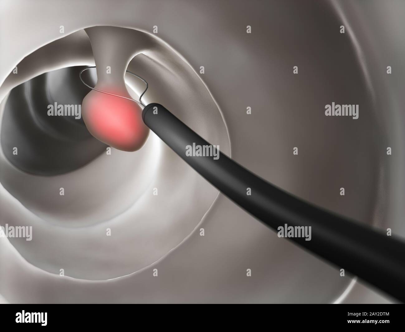 3d rendered illustration of a polyp removal Stock Photo - Alamy