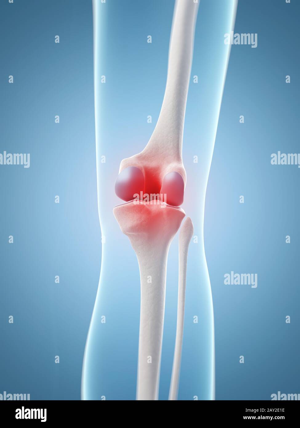Inflamed joint hi-res stock photography and images - Alamy