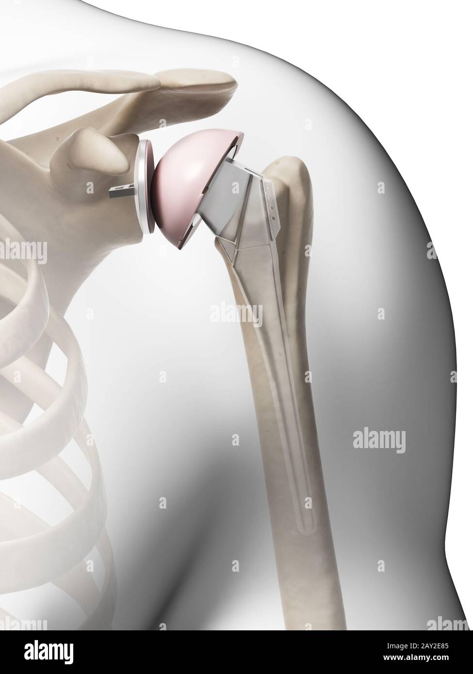 3d rendered illustration of a shoulder replacement Stock Photo - Alamy