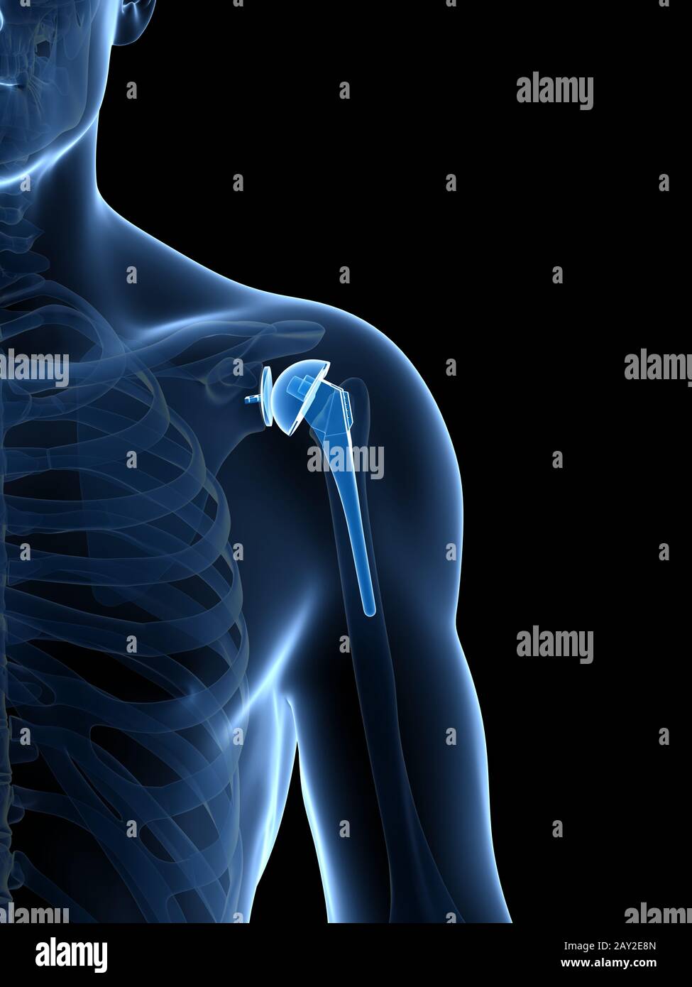3d rendered illustration of a shoulder replacement Stock Photo - Alamy