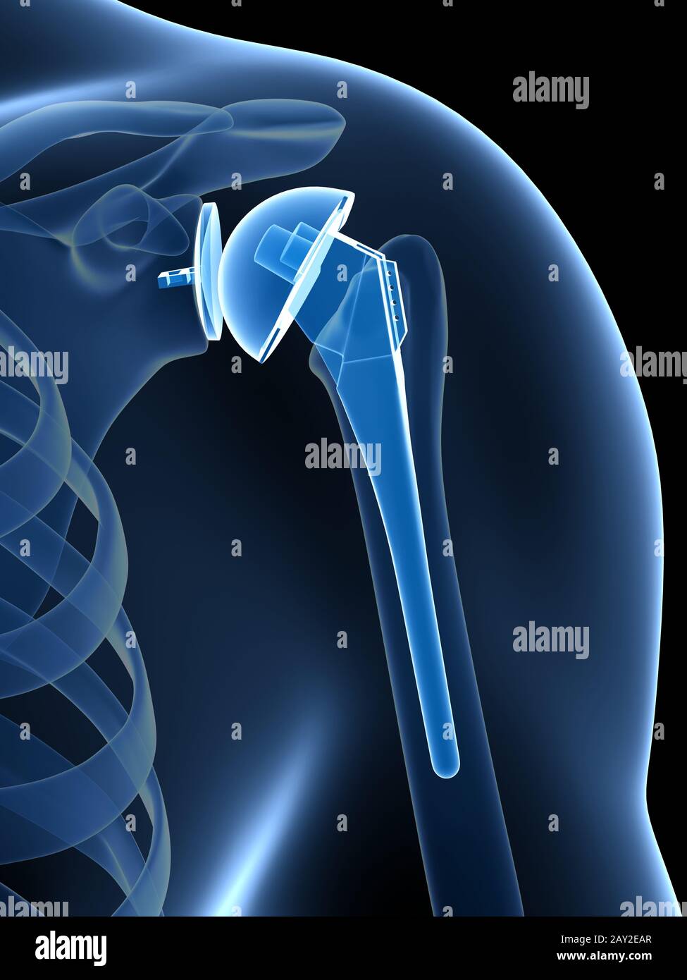 Human shoulder replacement hi-res stock photography and images - Alamy