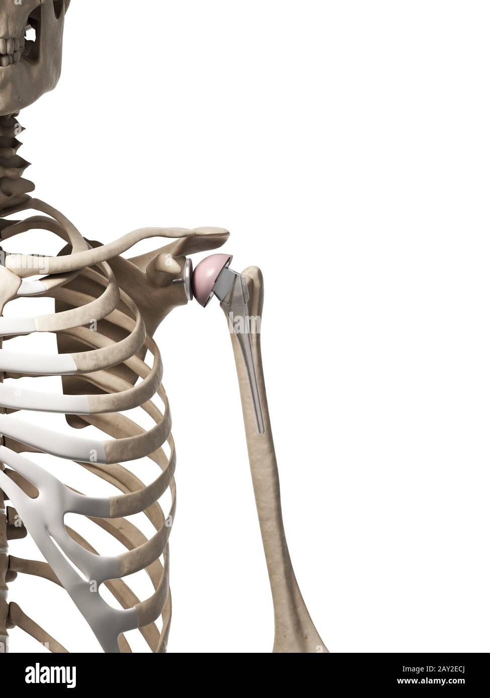 Human shoulder replacement hi-res stock photography and images - Alamy