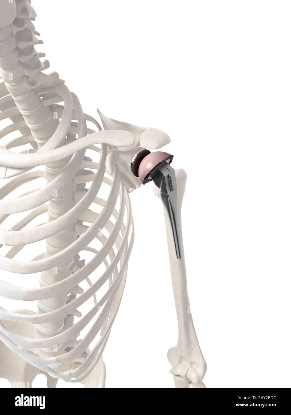 3d rendered illustration of a shoulder replacement Stock Photo - Alamy