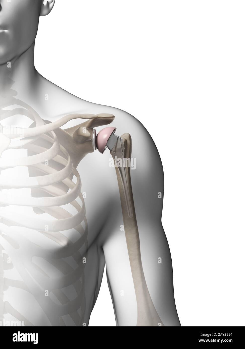 3d rendered illustration of a shoulder replacement Stock Photo - Alamy