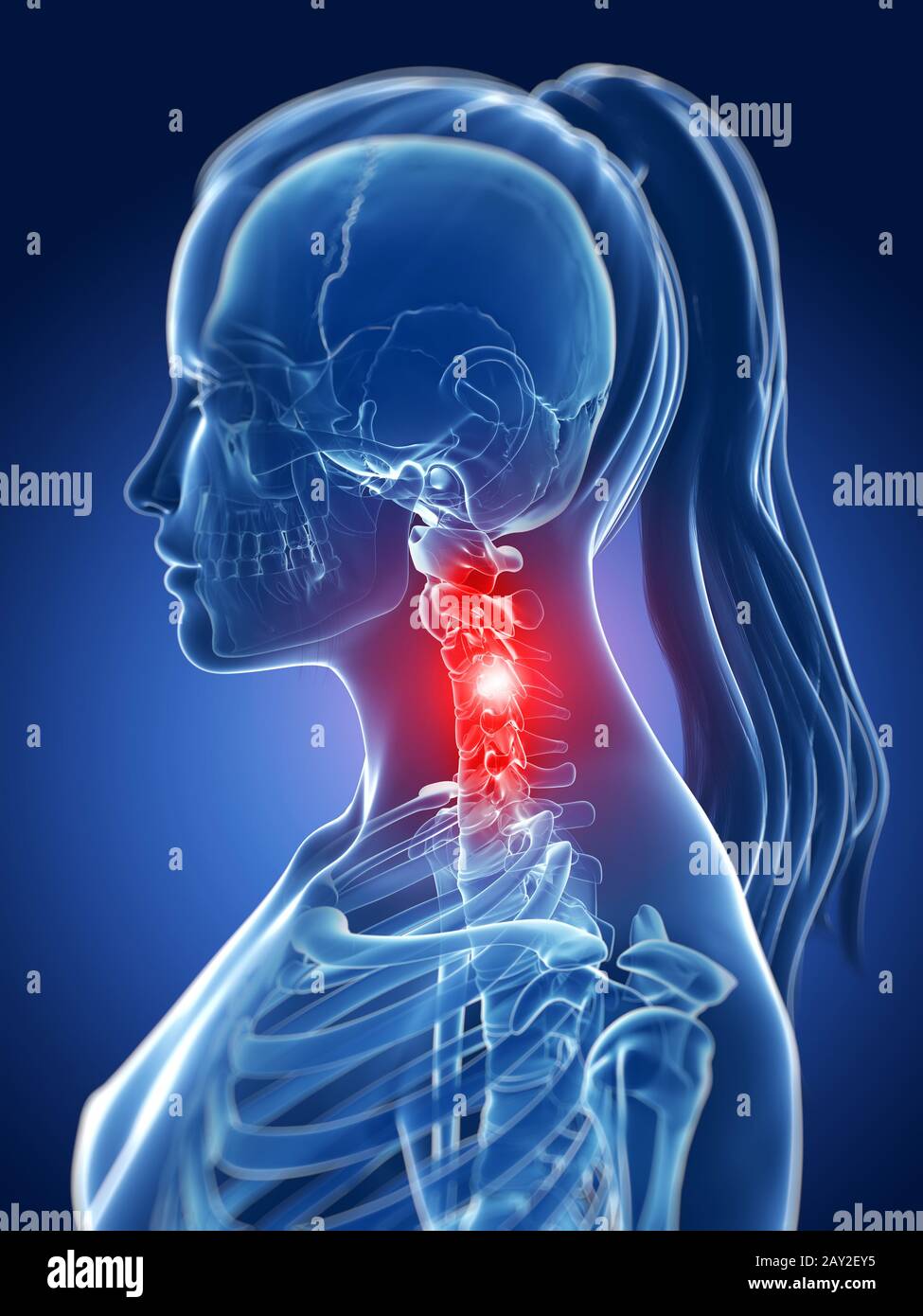 3d rendered medical illustration - painful neck Stock Photo - Alamy