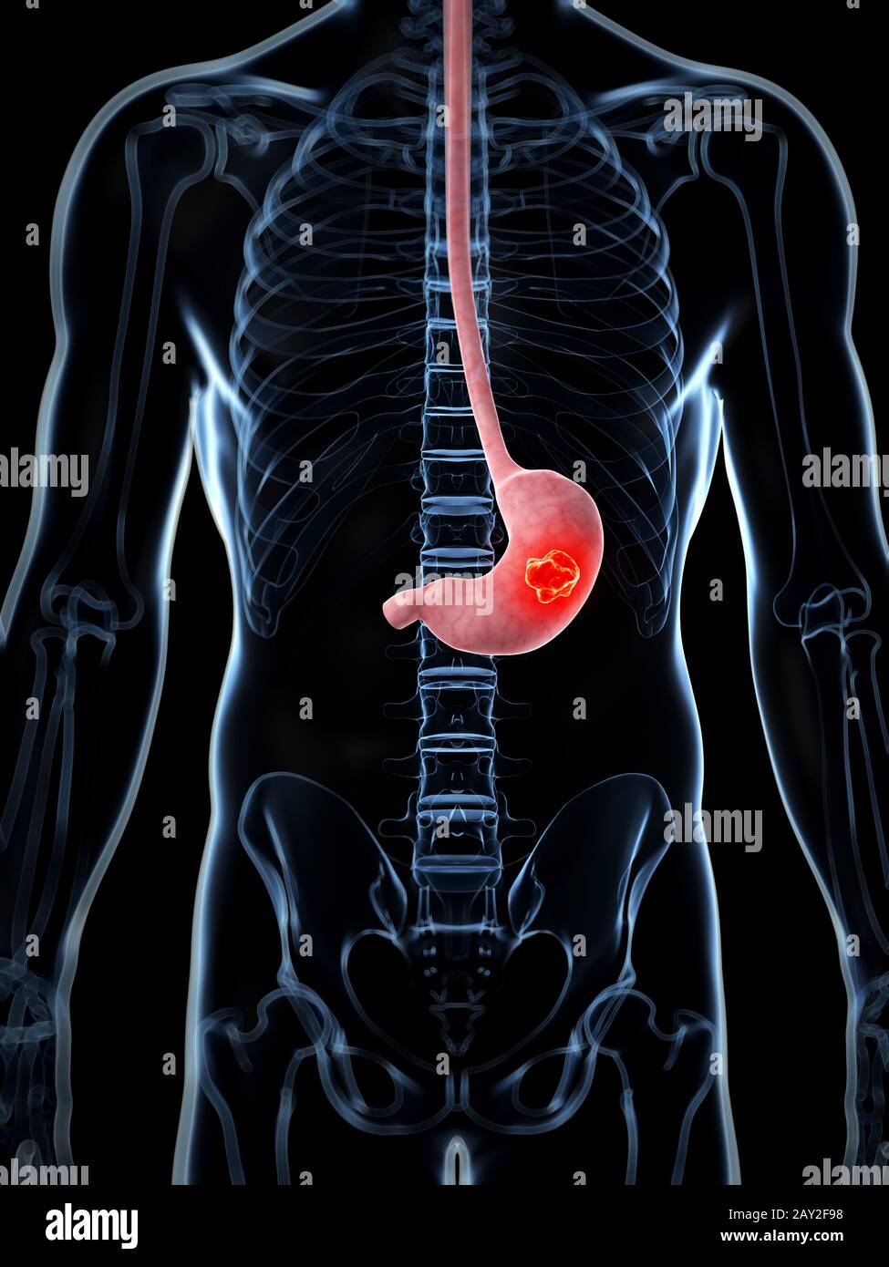 3d rendered illustration of the male stomach - cancer Stock Photo - Alamy