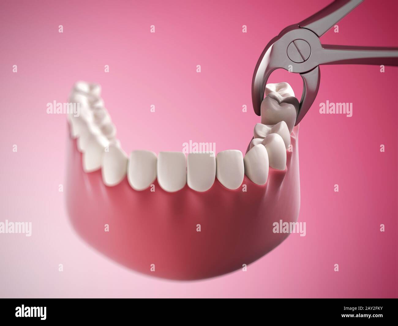 3d rendered illustration of a tooth extraction Stock Photo - Alamy