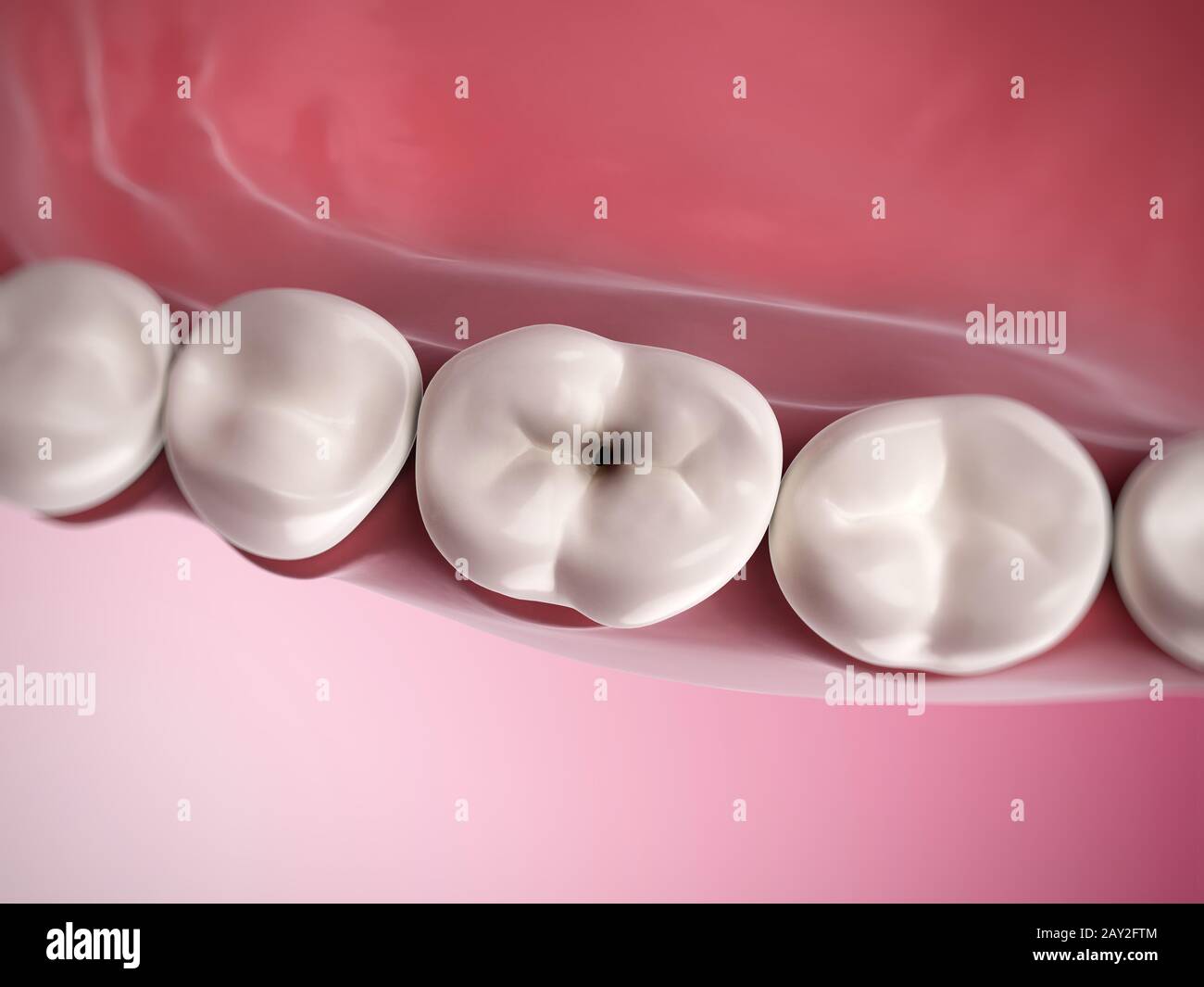 3d rendered illustration of tooth decay Stock Photo - Alamy