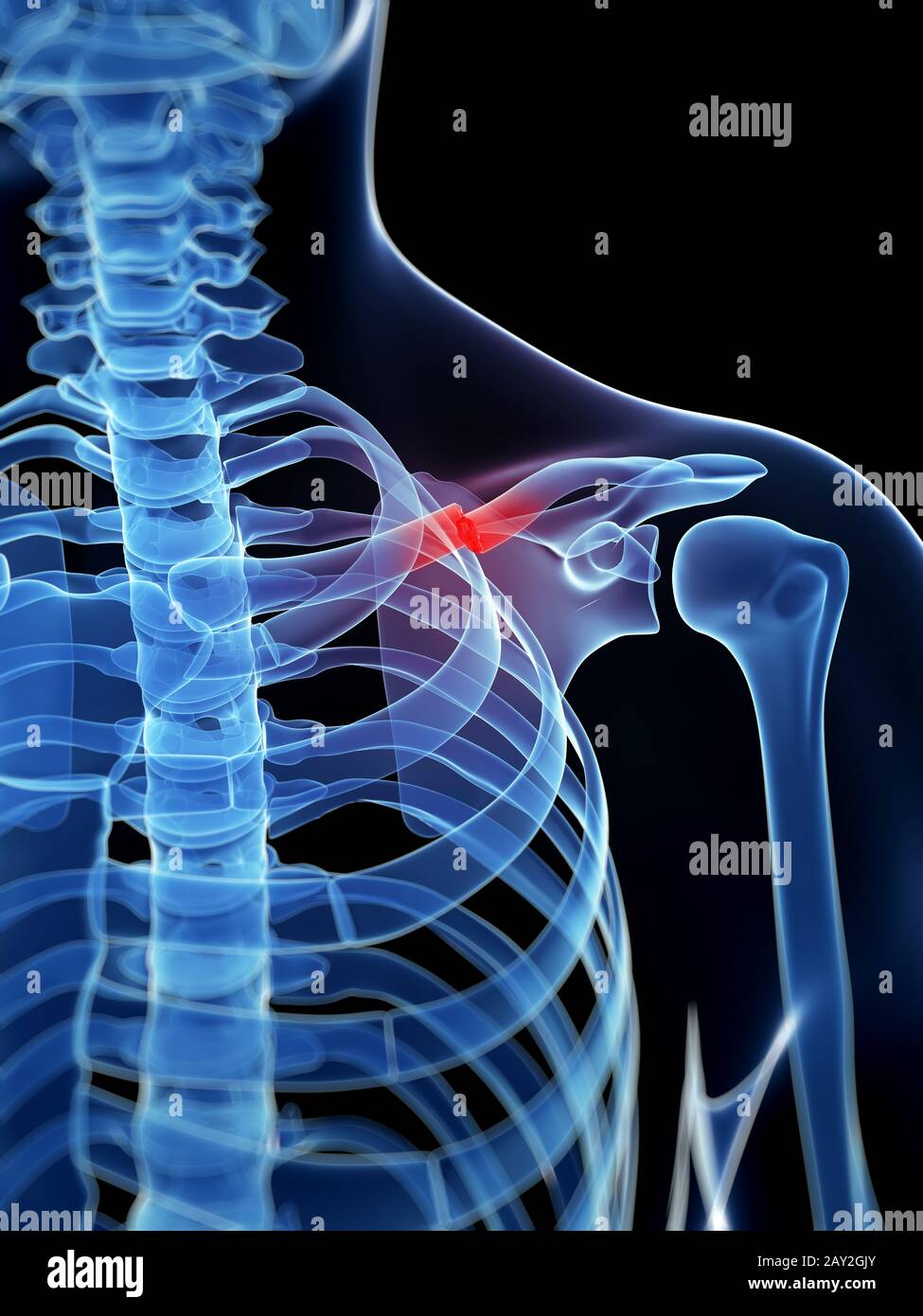 medical illustration of a broken clavicle Stock Photo - Alamy