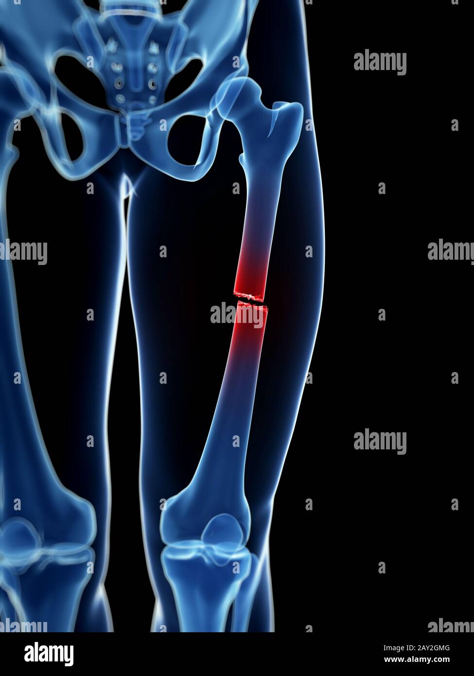 Broken upper leg bone hi-res stock photography and images - Alamy