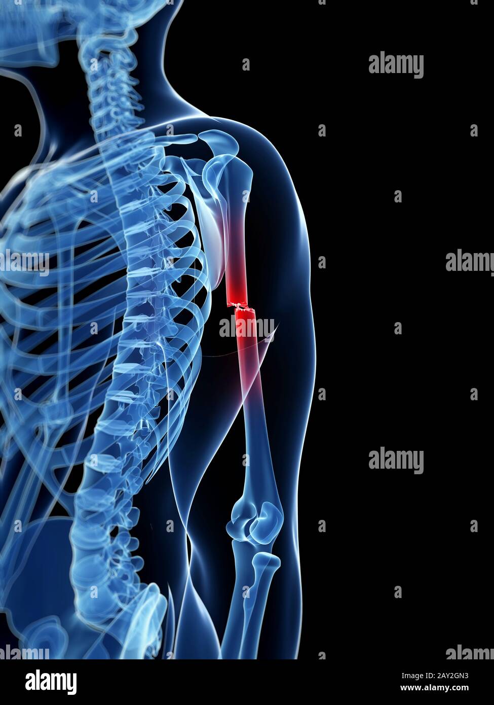 X ray of a broken arm hi-res stock photography and images - Alamy