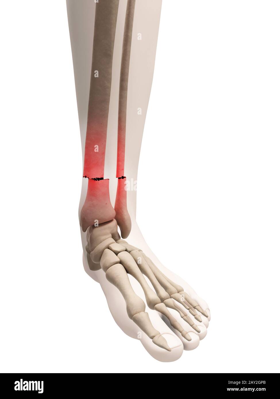 medical illustration of a broken leg bone Stock Photo - Alamy