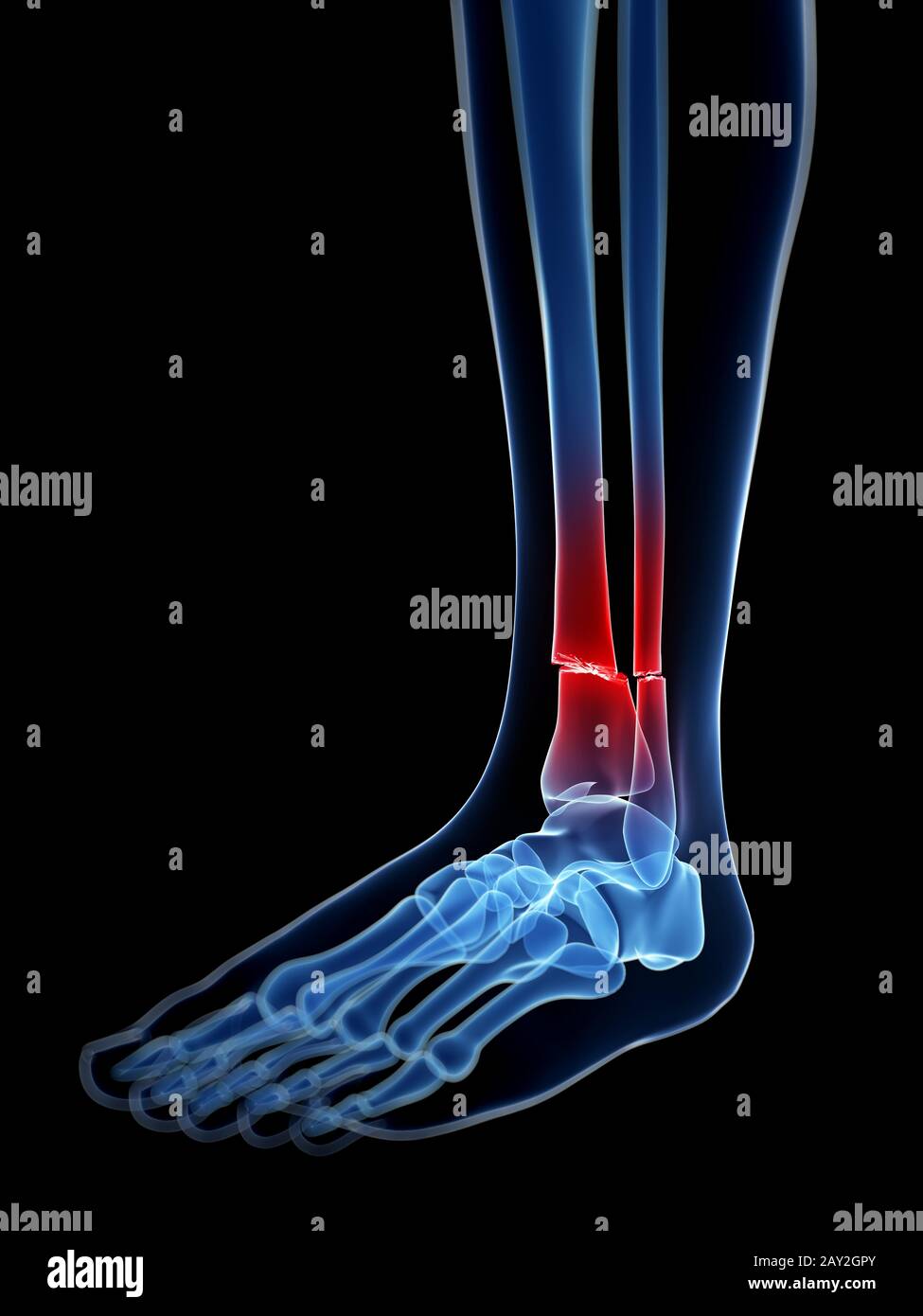 medical illustration of a broken leg bone Stock Photo - Alamy