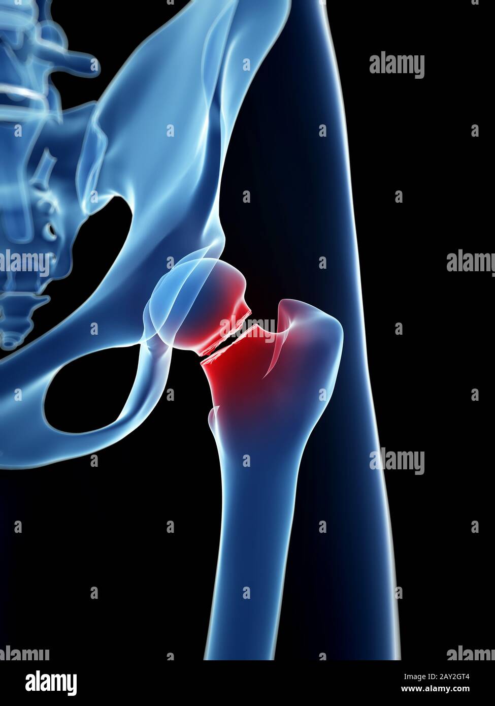 medical illustration of broken hip Stock Photo - Alamy