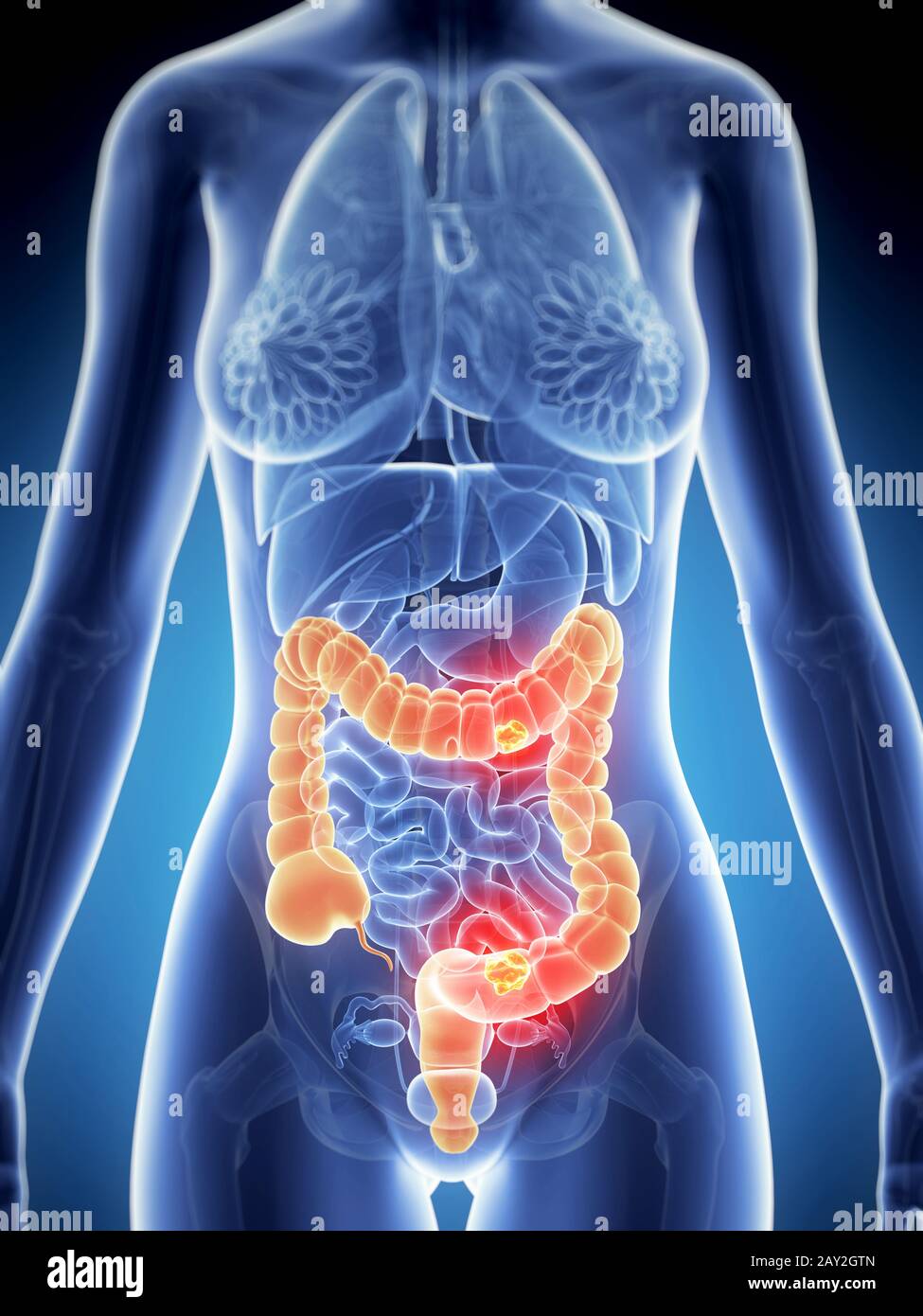 Cancer of the colon hi-res stock photography and images - Alamy