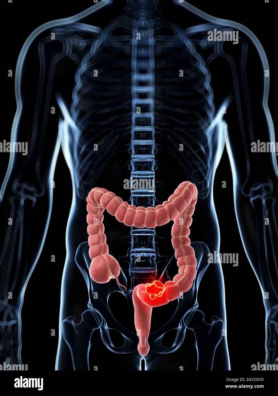 3d rendered illustration of the male colon - cancer Stock Photo - Alamy