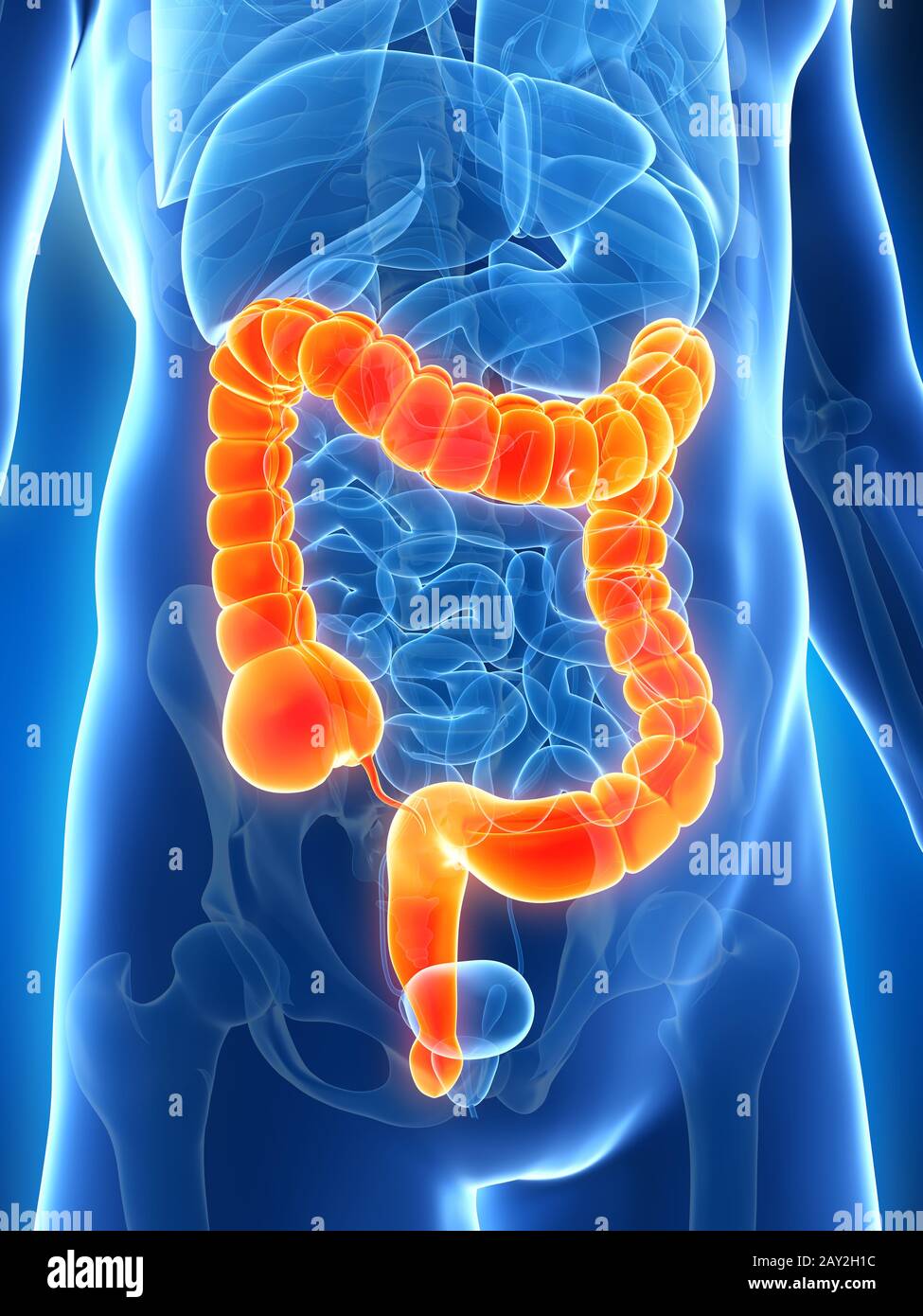 Inflamed colon hi-res stock photography and images - Alamy