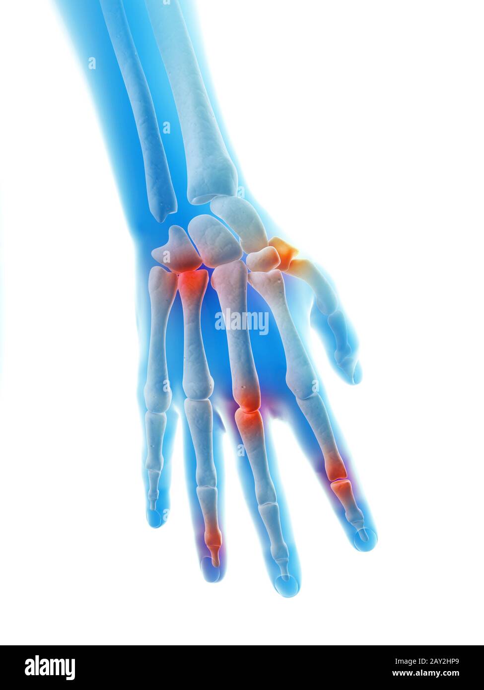 Inflamed gout hi-res stock photography and images - Alamy