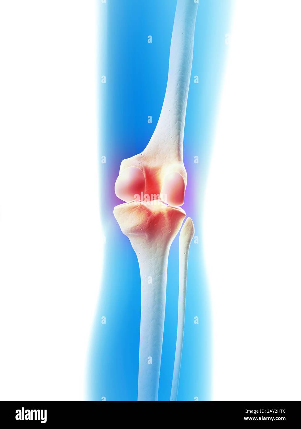 Painful inflamed gout on hi-res stock photography and images - Alamy