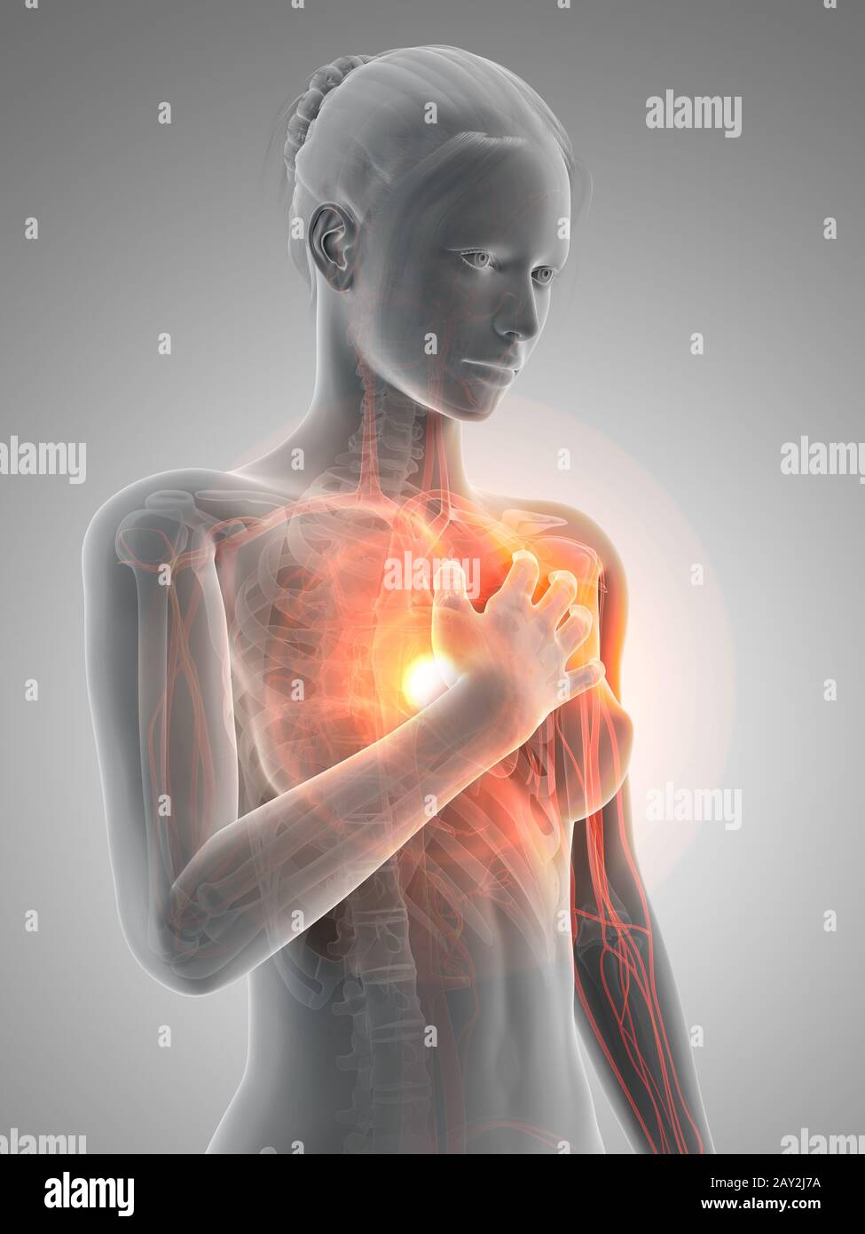 Human heart attack, illustration hi-res stock photography and images ...