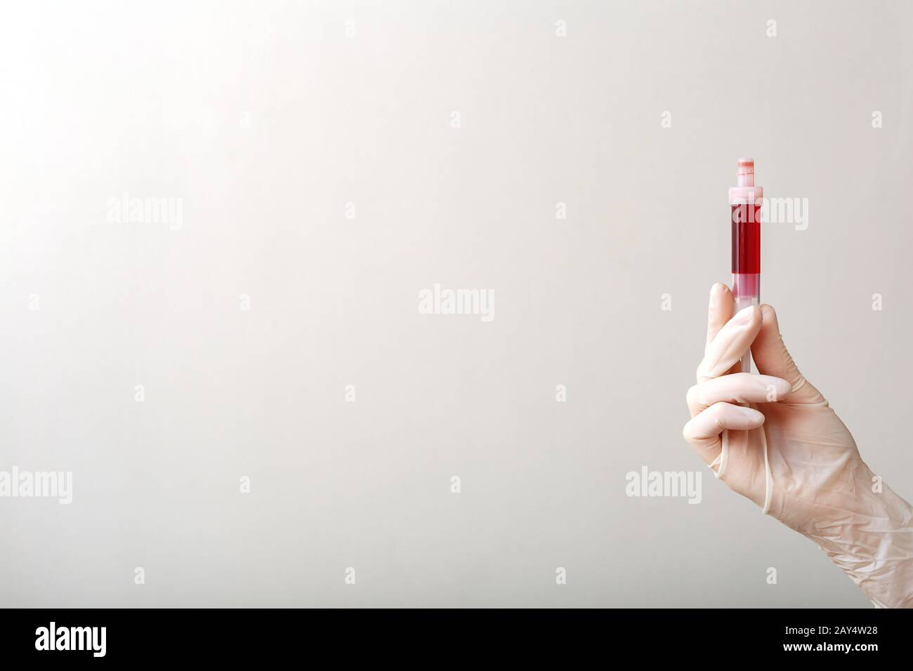 Blood test in tube for laboratory analysis in doctors hand. Laboratory ...