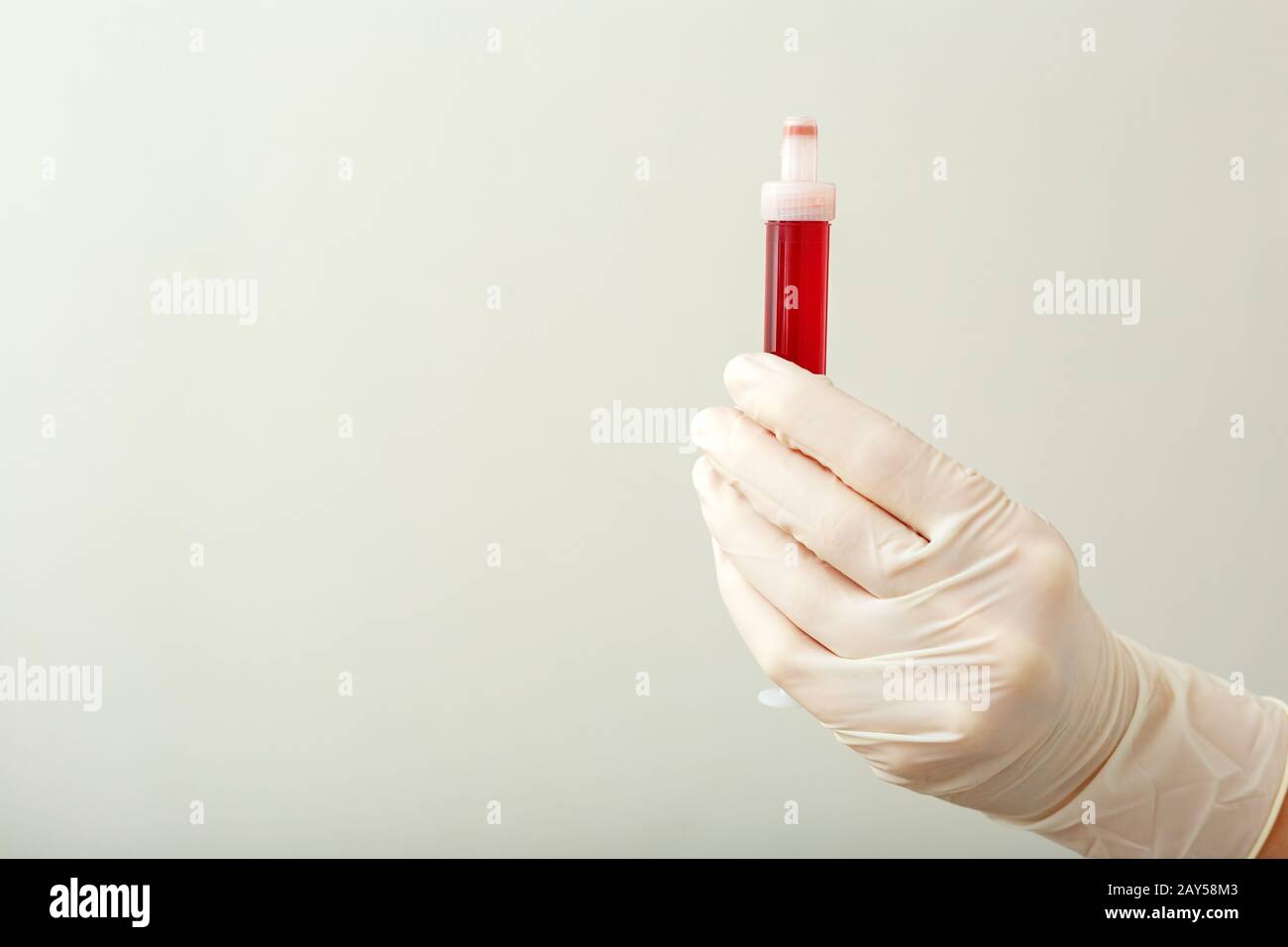 Blood test in tube for laboratory analysis in doctors hand. Laboratory ...