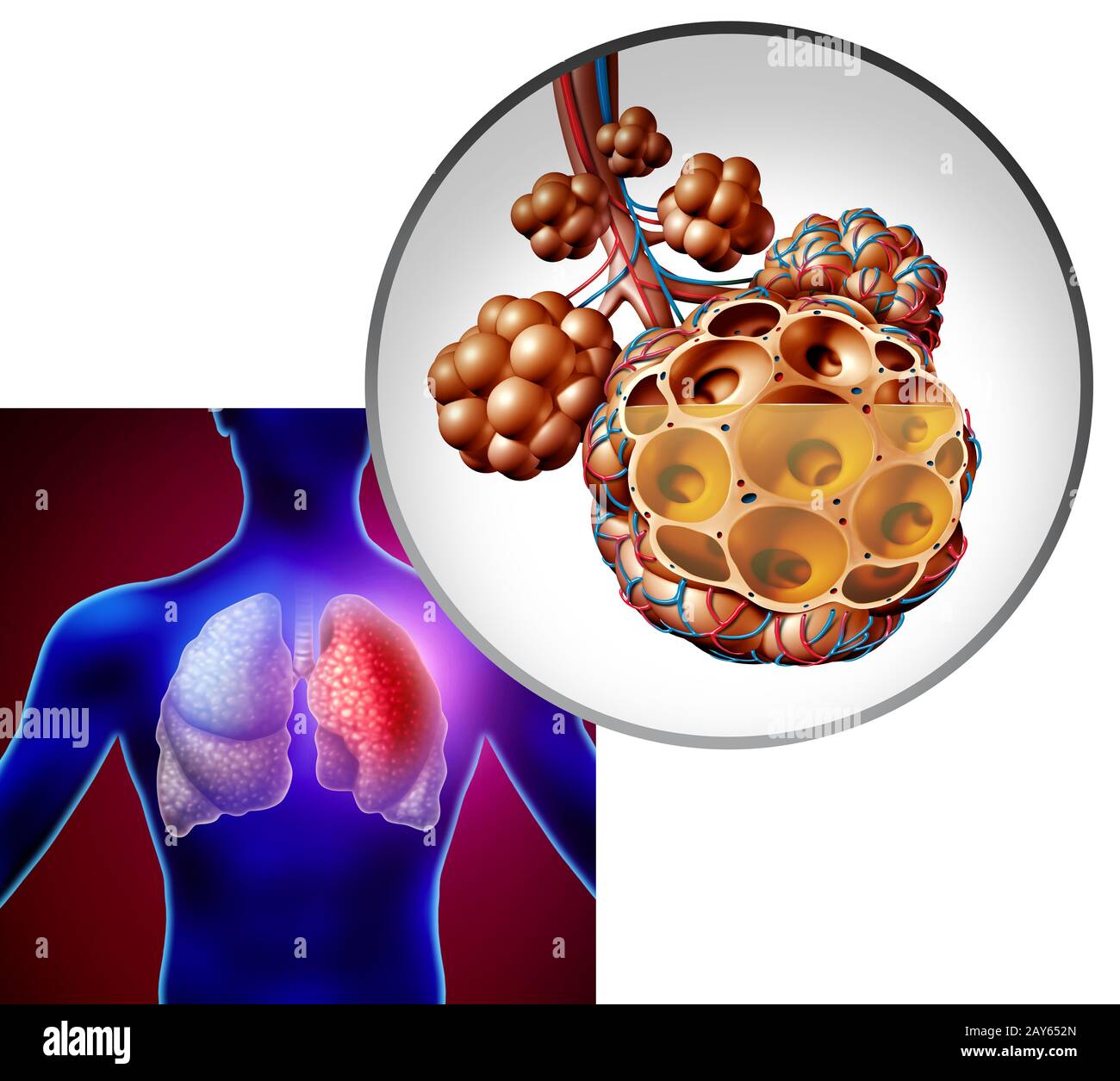 Human Lung Infection And Respiratory Inflammation Disease As Influenza