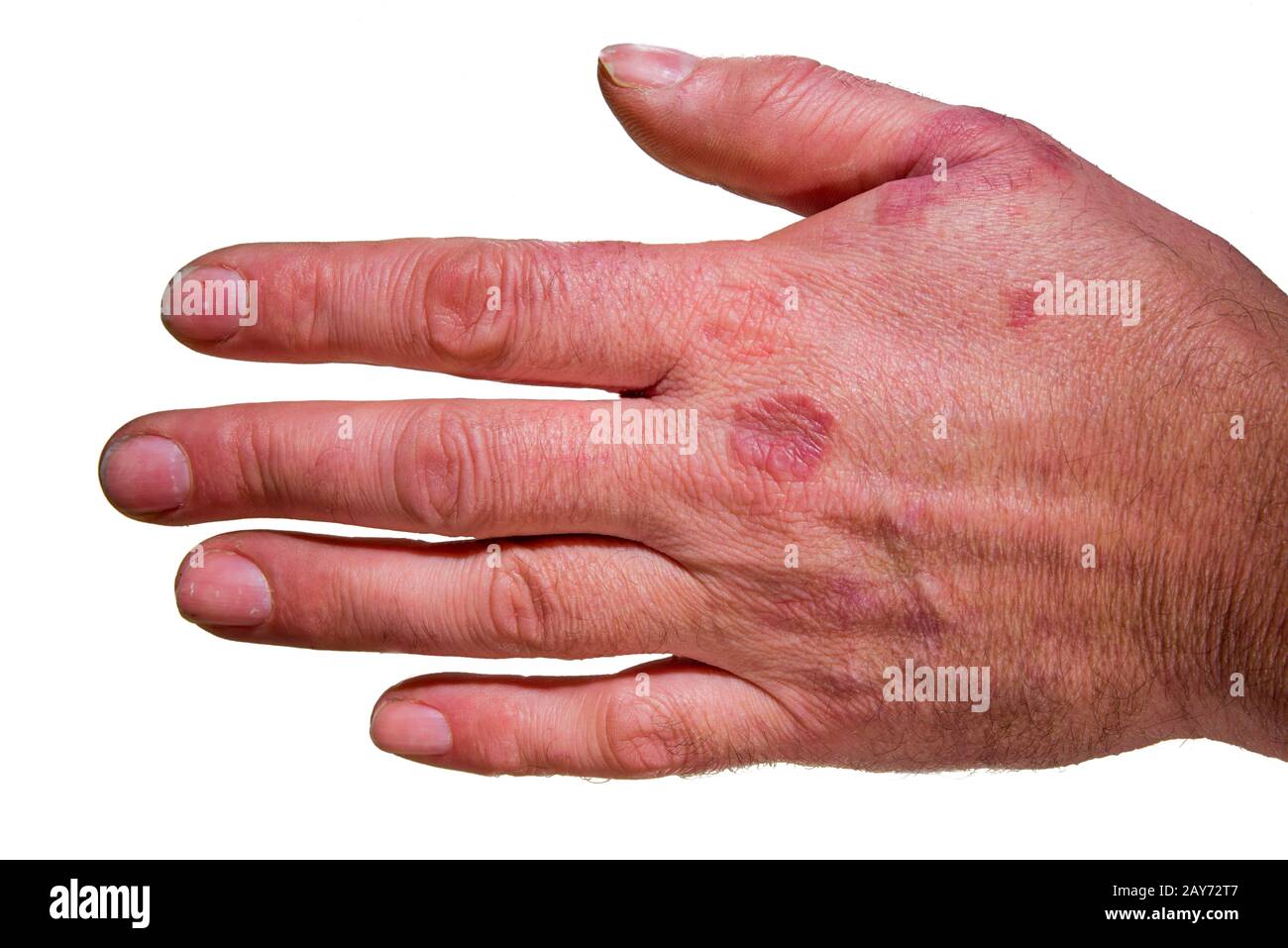 Human hand with rash / eczema Isolated on white Stock Photo - Alamy