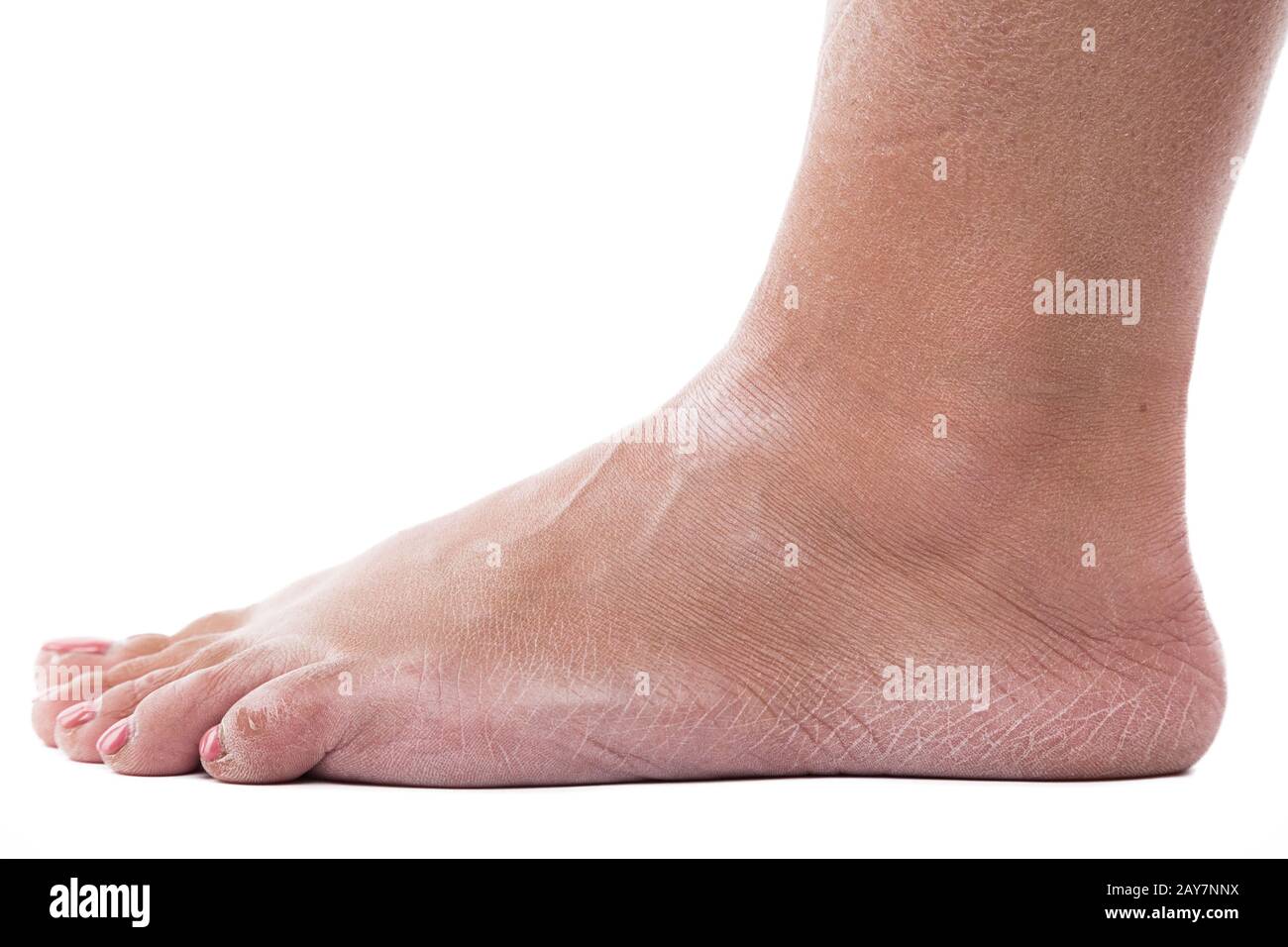 dehydrated skin on the heels of female feet Stock Photo - Alamy