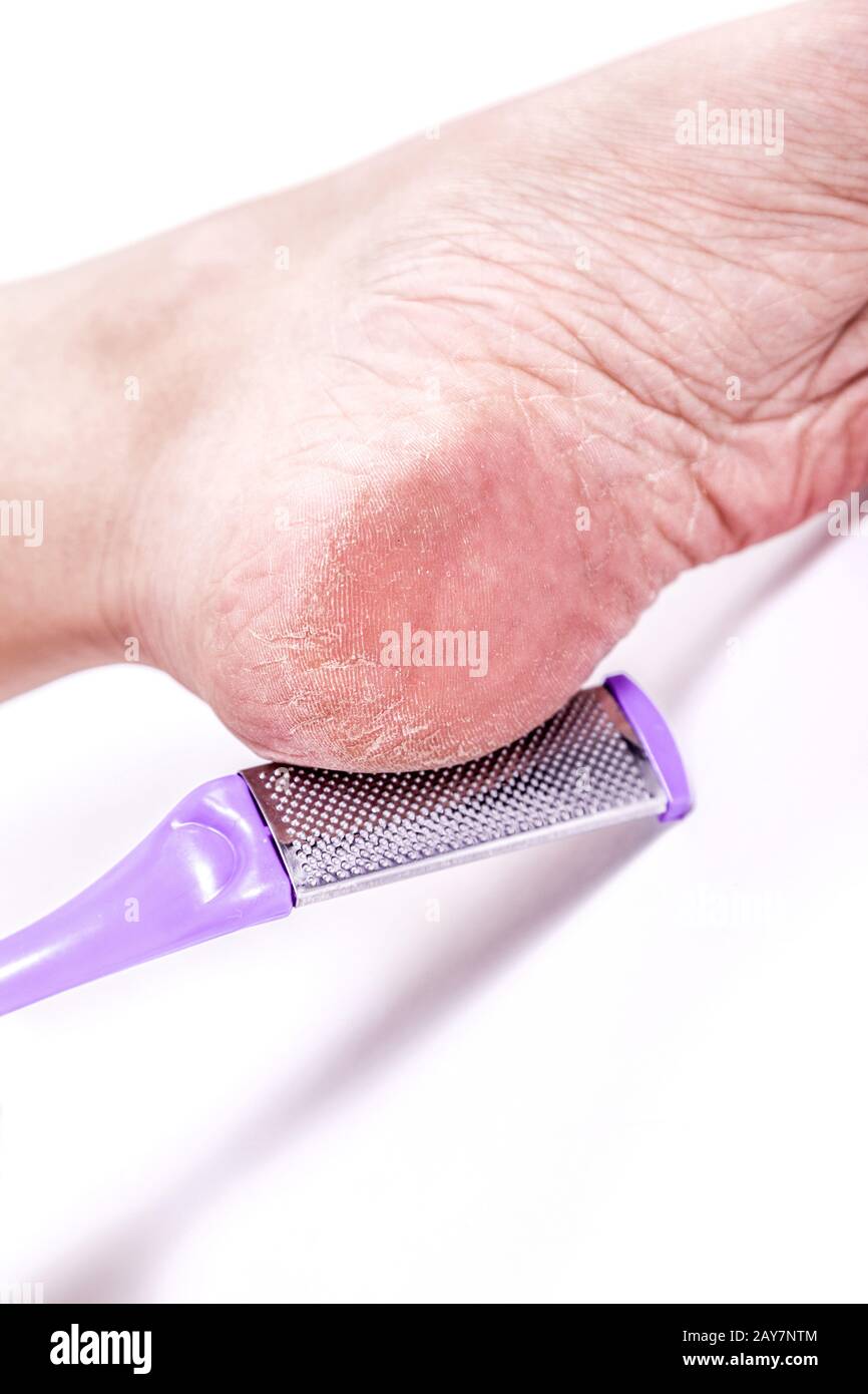 female legs with overdried dehydrated dry skin on heels closeup Stock ...