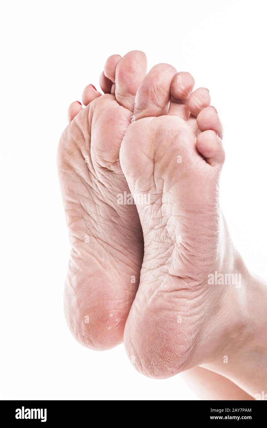 female foot with pedicure and poor over-dry skin on the heels of Stock ...