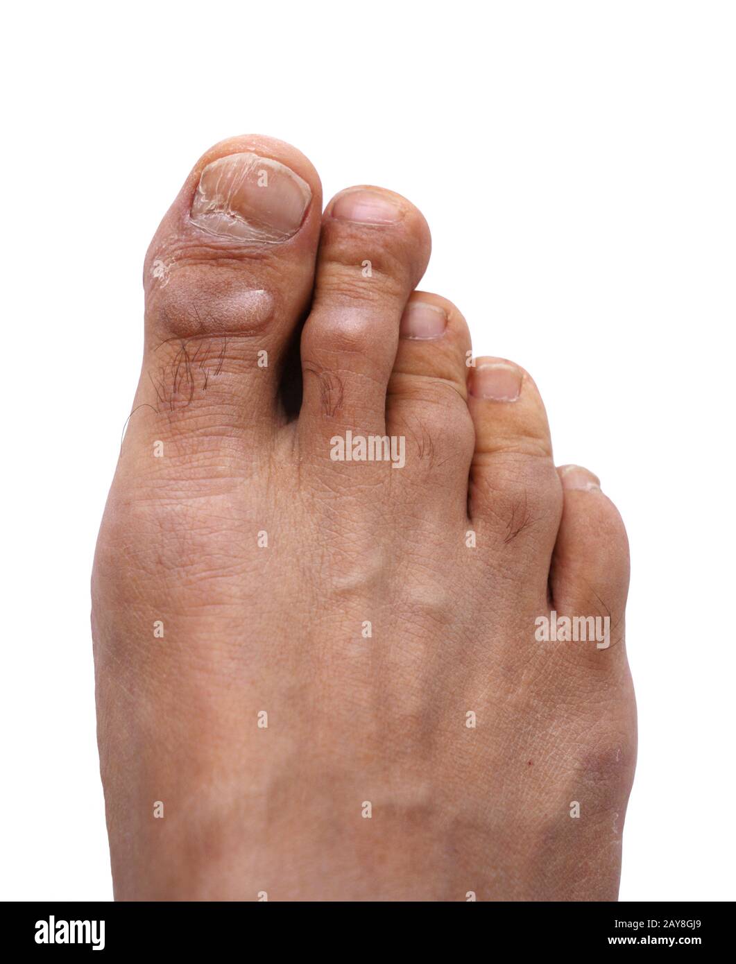 Distal phalanges hi-res stock photography and images - Alamy