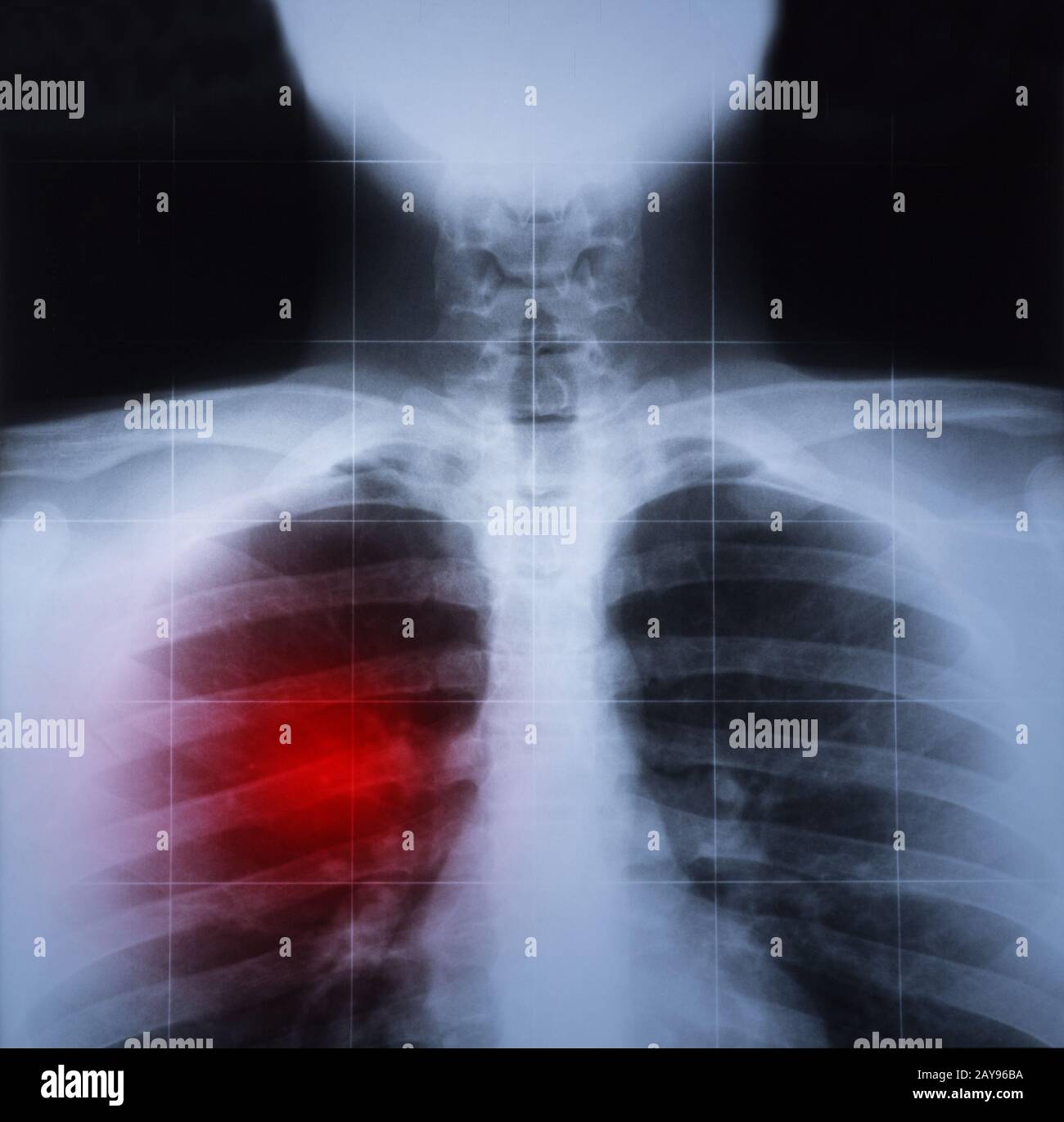 X ray image of chest and lung disease highlighted in red Stock Photo ...