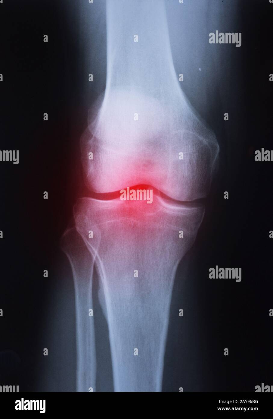 Rheumatoid arthritis x ray knee hi-res stock photography and images - Alamy