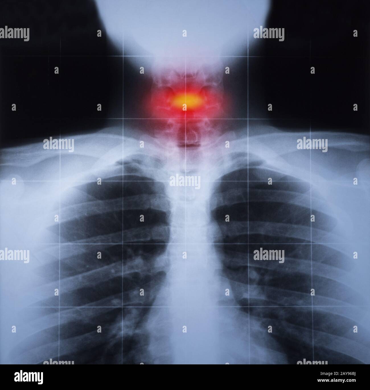 X ray image of chest and cervical trauma highlighted in red Stock Photo ...