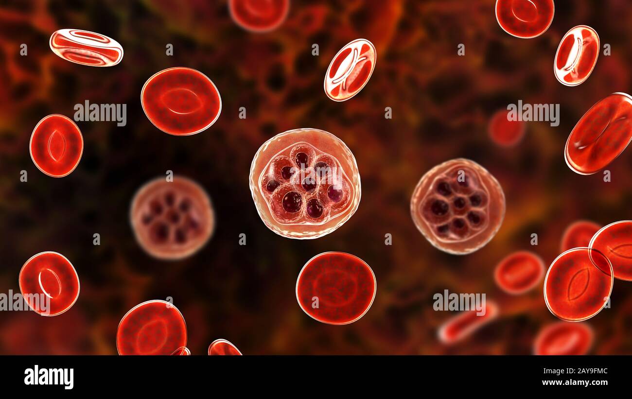 Malaria infection, illustration Stock Photo - Alamy