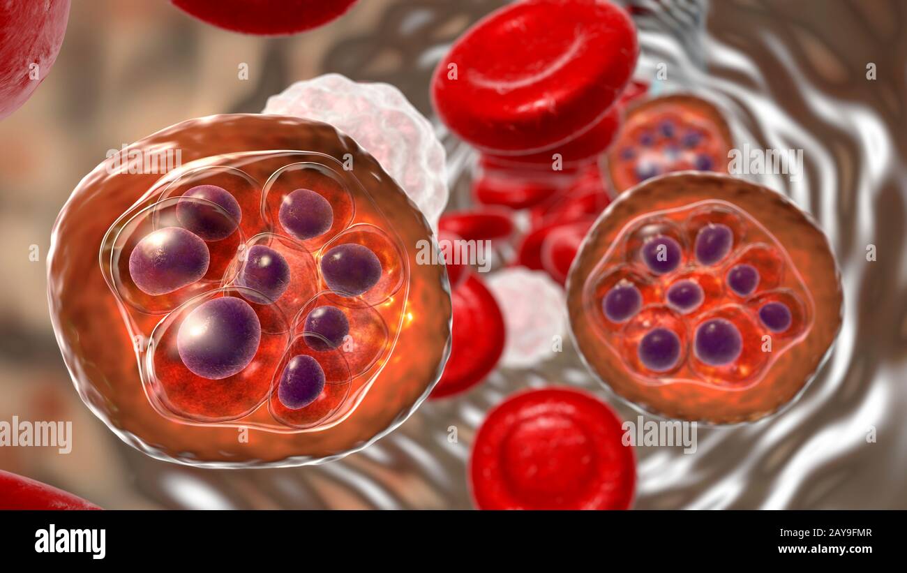 Malaria infection, illustration Stock Photo - Alamy