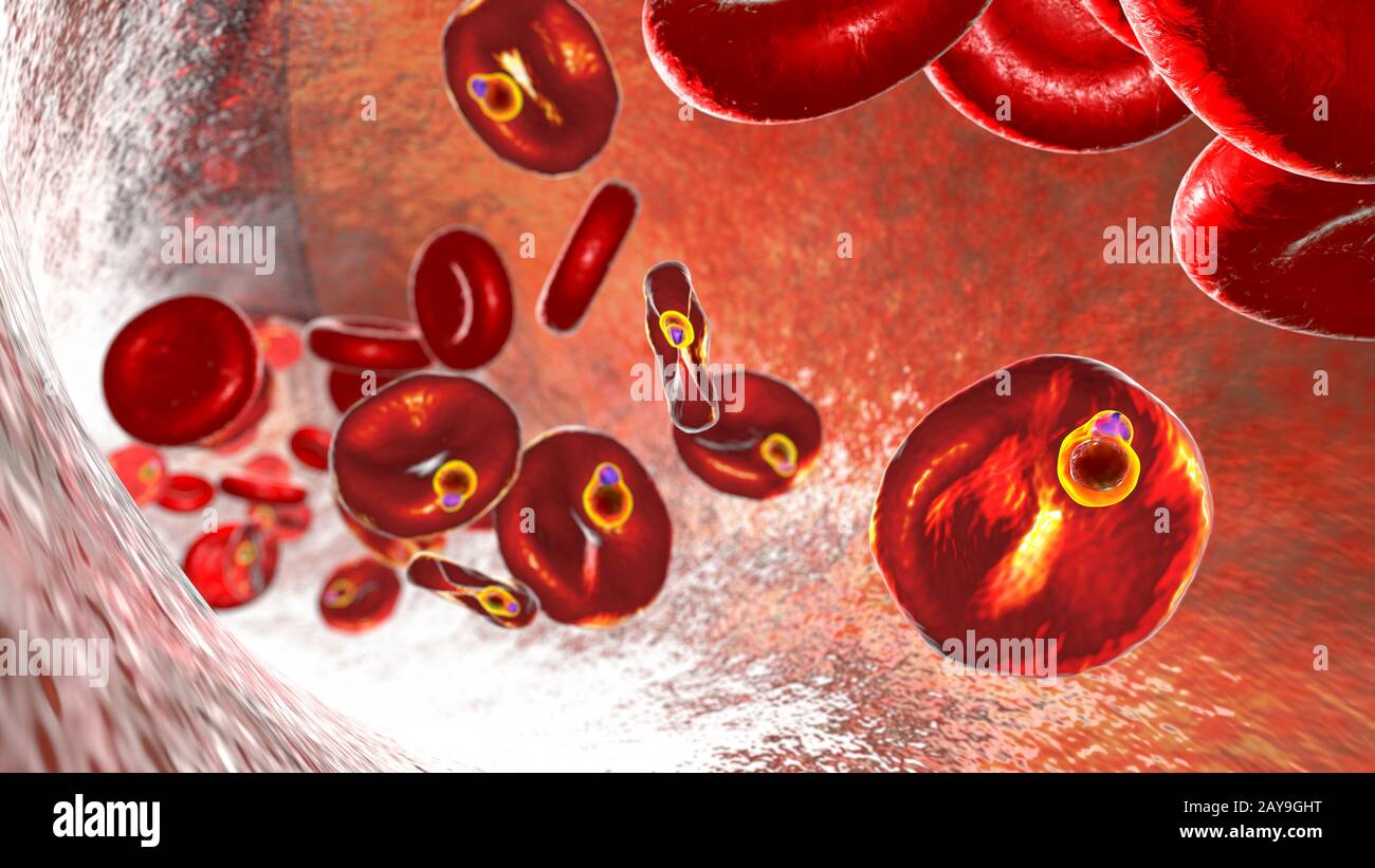 Plasmodium malariae inside red blood cell, illustration Stock Photo - Alamy