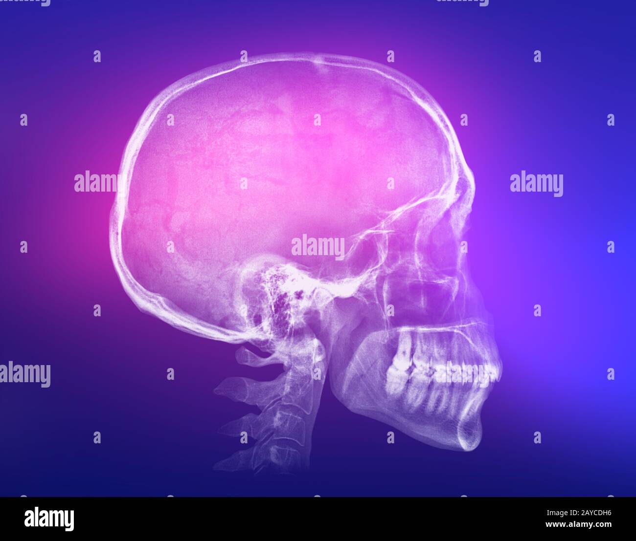 Skull x ray hi-res stock photography and images - Alamy