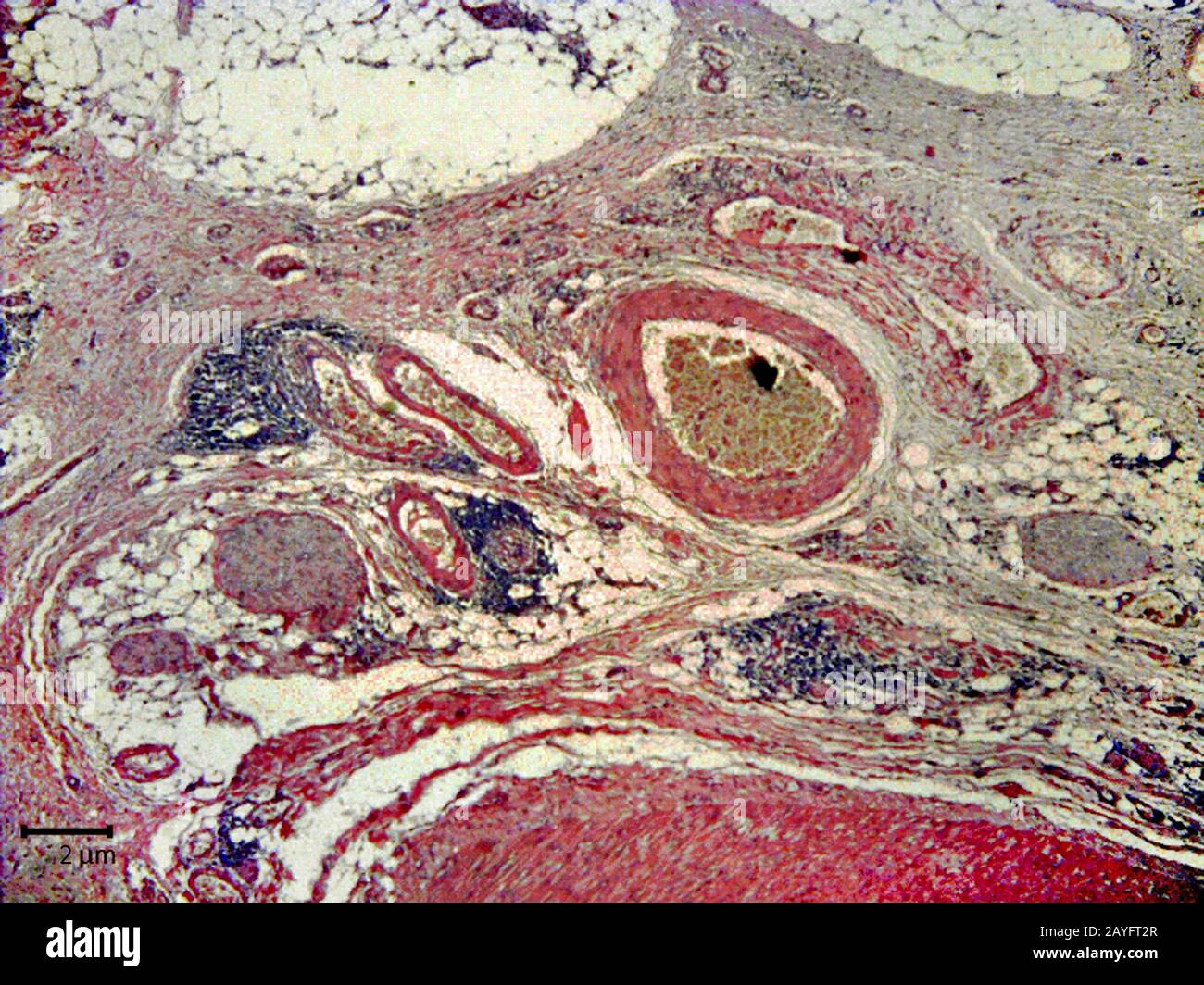 Stomach cancer hi-res stock photography and images - Alamy