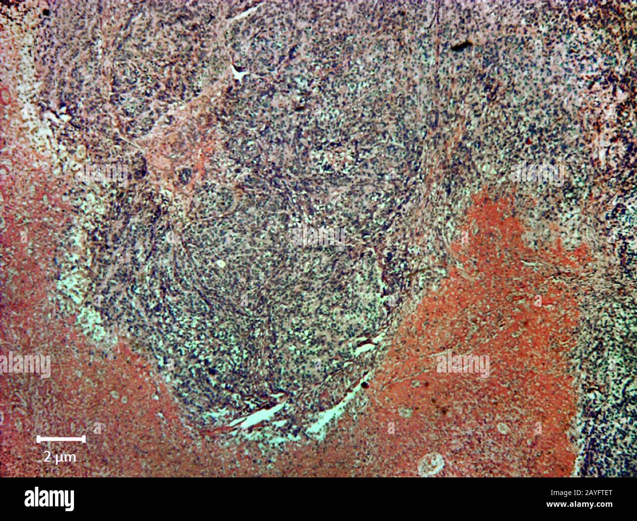 Skin cancer melanoma malignant hi-res stock photography and images - Alamy