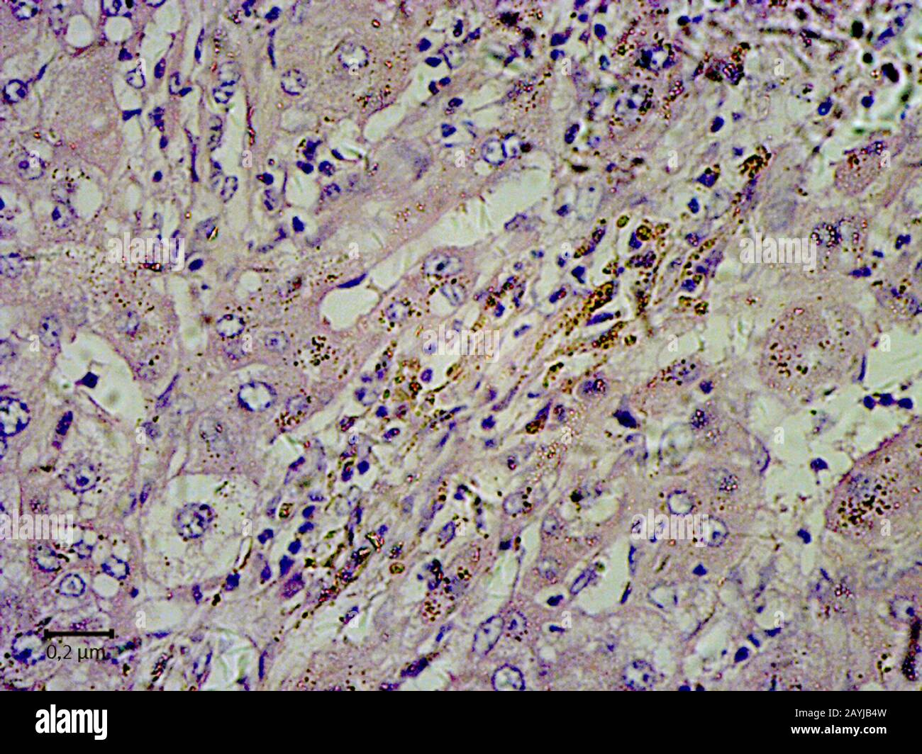 histological cut of tissue of primary hepatic cancer, 2000 x Stock ...