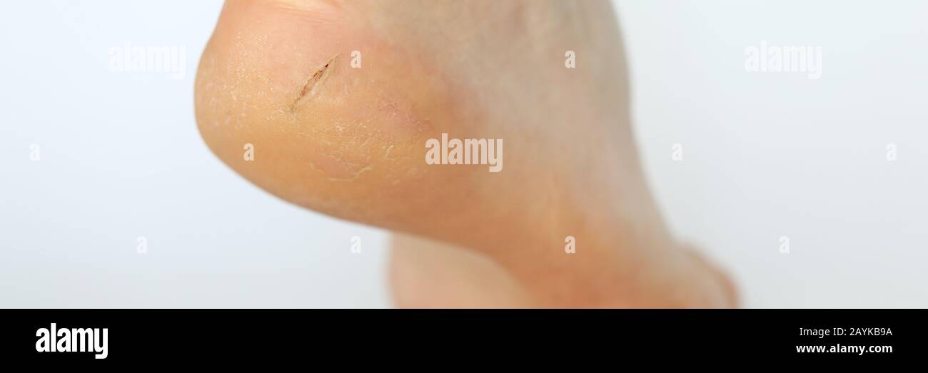 Cracked toe hi-res stock photography and images - Alamy
