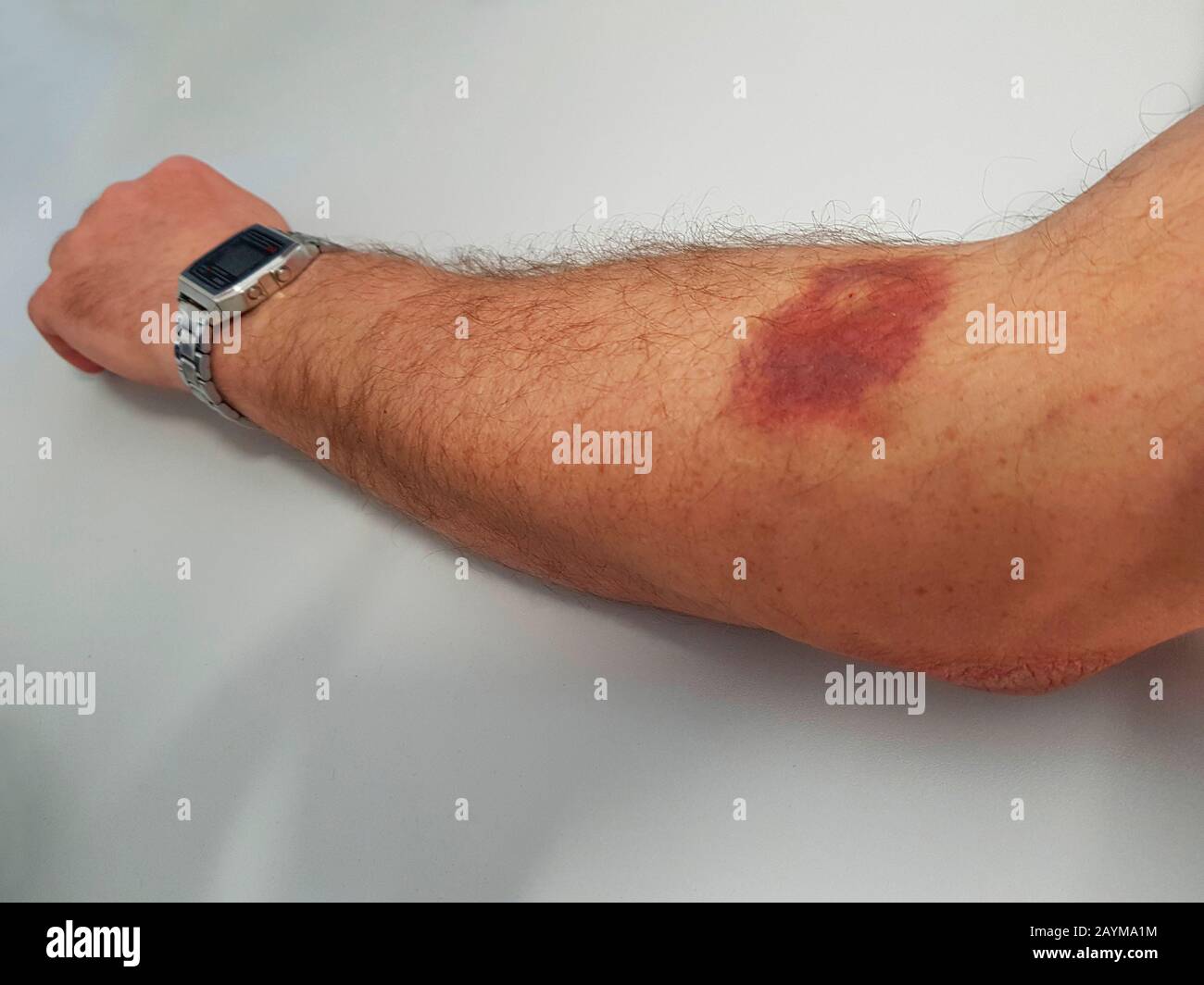 bruise at an arm after placing a catheter and using a blood thinner ...