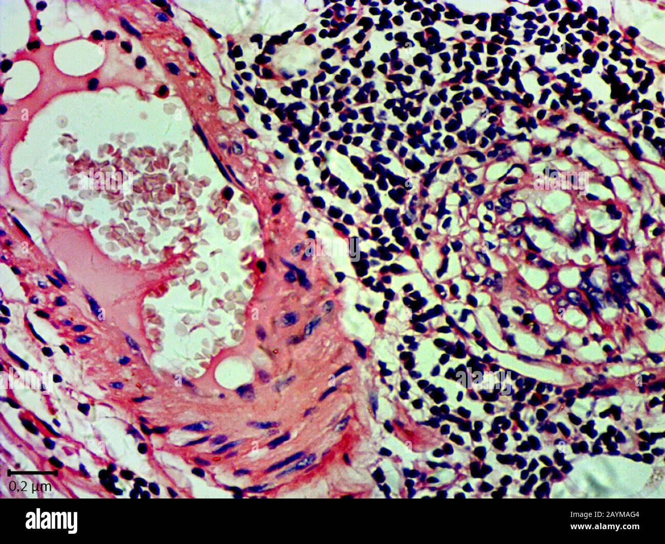 Stomach cancer horizontal hi-res stock photography and images - Alamy