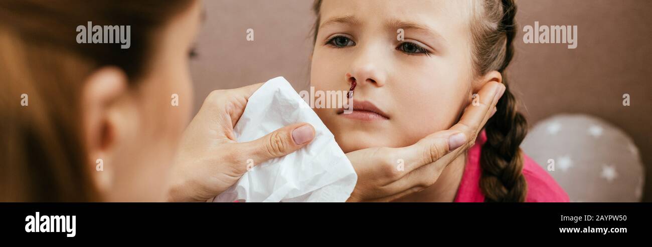 Nose bleeding child hi-res stock photography and images - Alamy